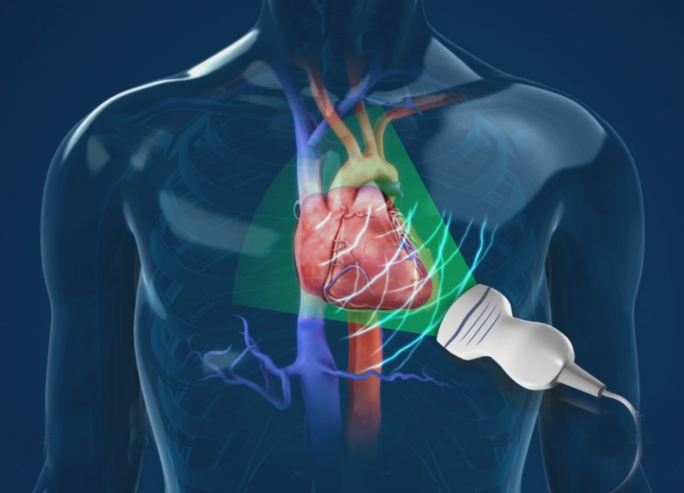 2-D Echocardiogram | Gemini Imaging Group